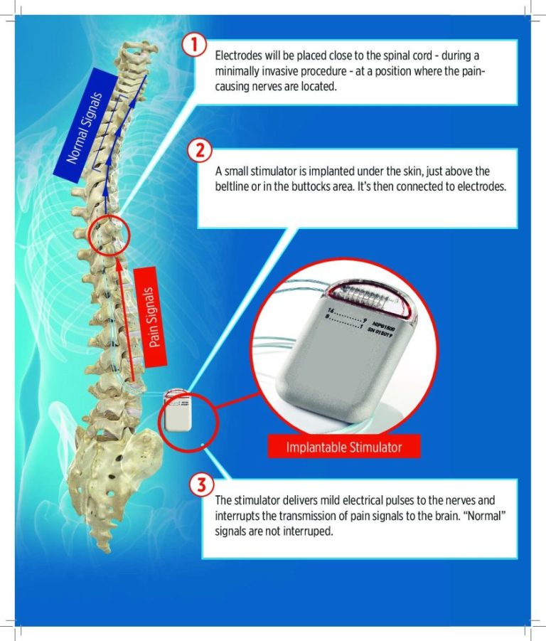 Preventing and Managing Back Pain with Spinal Cord Stimulation and ...
